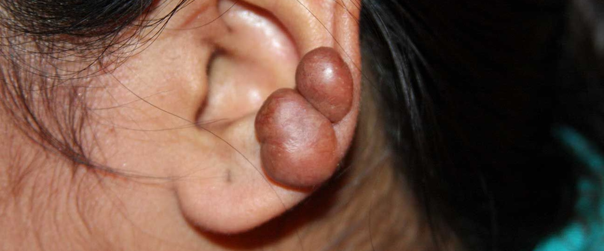 Understanding the Early Signs of Keloid Formation
