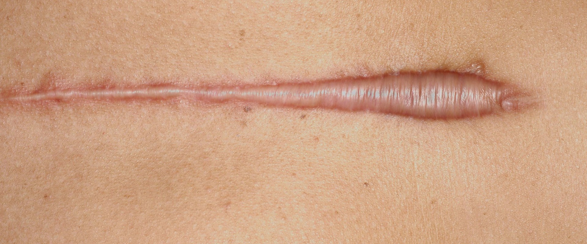 Understanding Keloids: What They Look Like and How to Treat Them