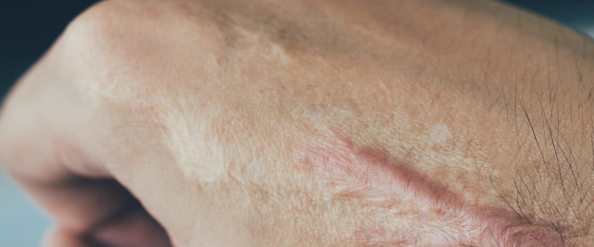 Understanding Keloids: What They Look Like and How to Treat Them